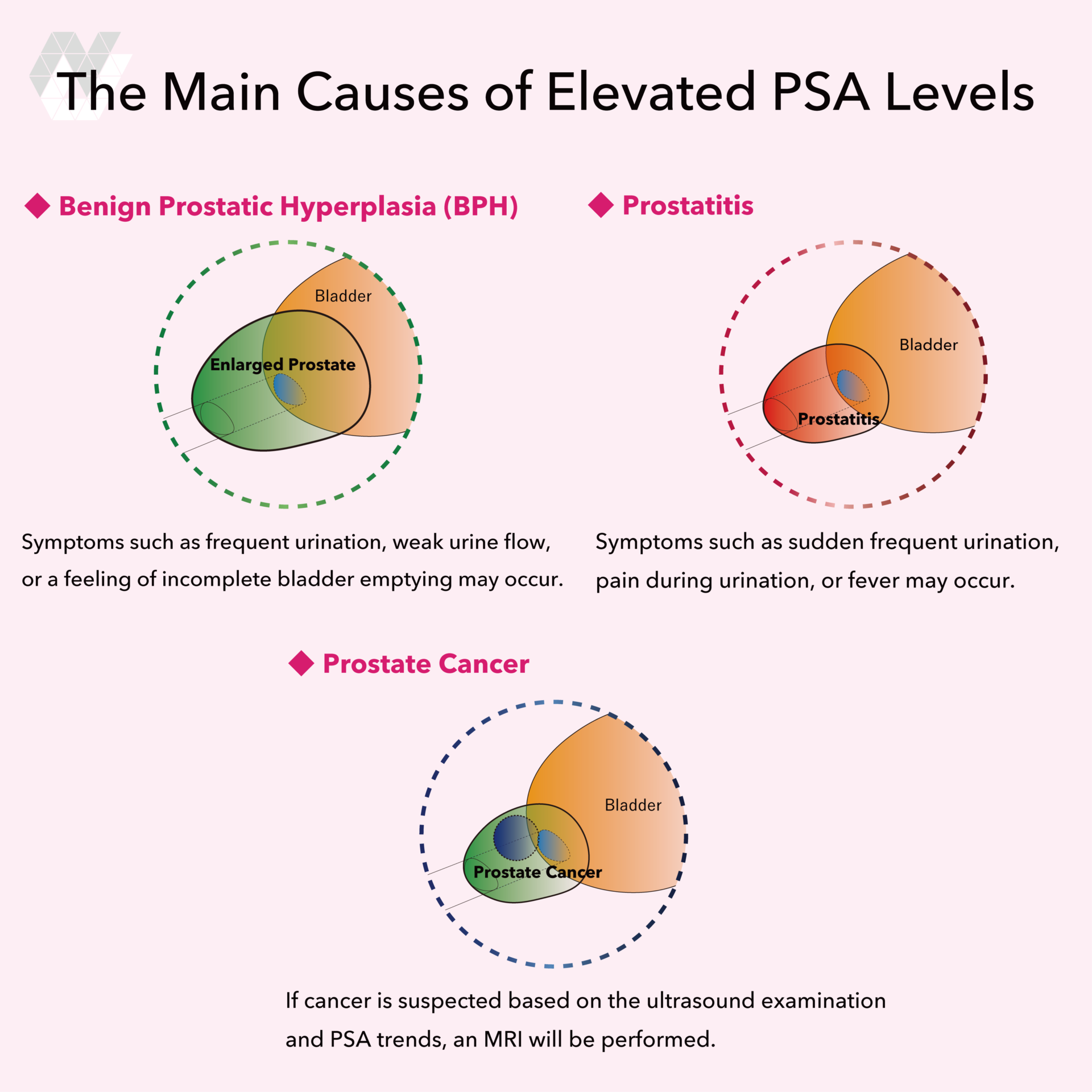 PSAについて | 西川口泌尿器科クリニック｜埼玉県川口市の泌尿器科