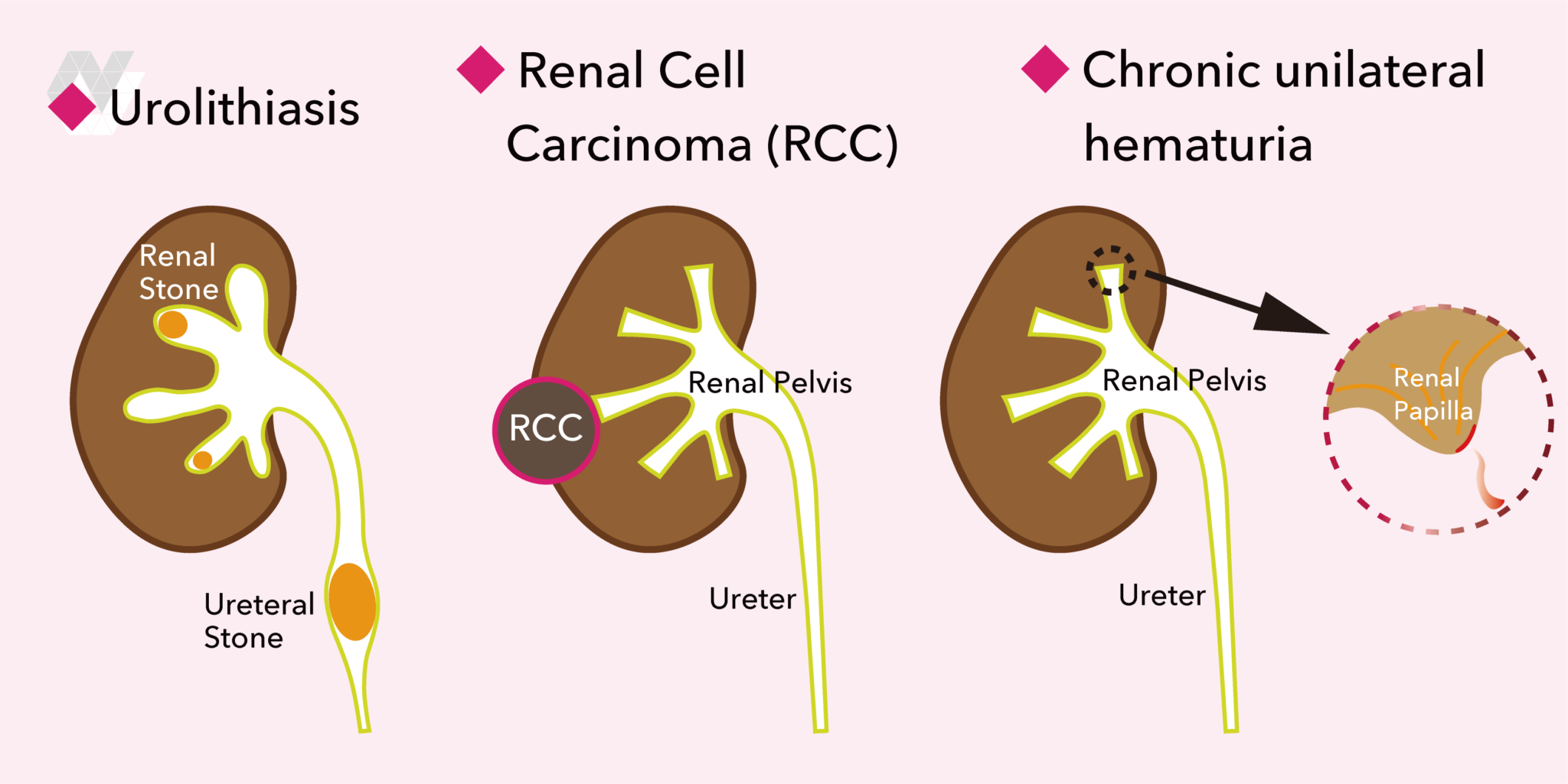 血尿について（Hematuria） | 西川口泌尿器科クリニック｜埼玉県川口市の泌尿器科