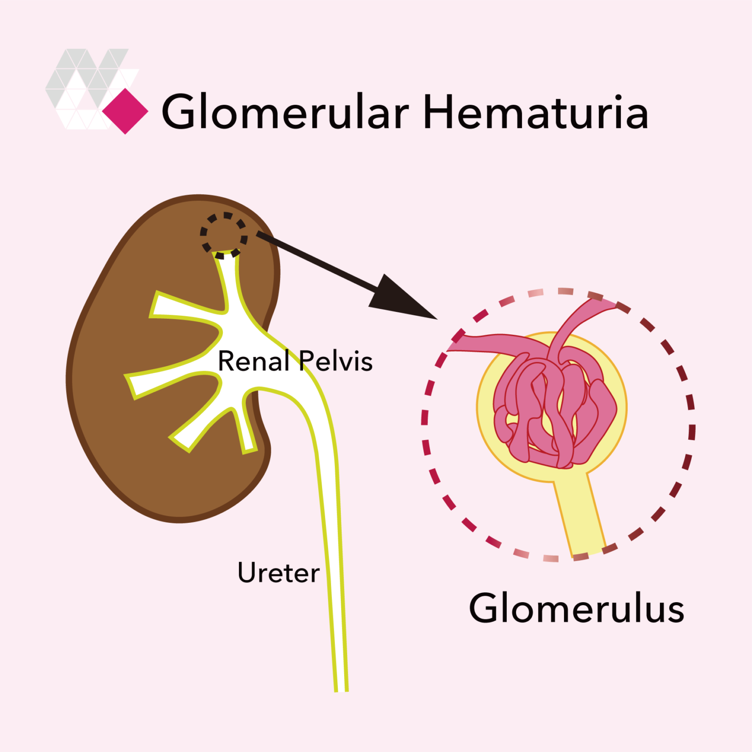 血尿について（Hematuria） | 西川口泌尿器科クリニック｜埼玉県川口市の泌尿器科
